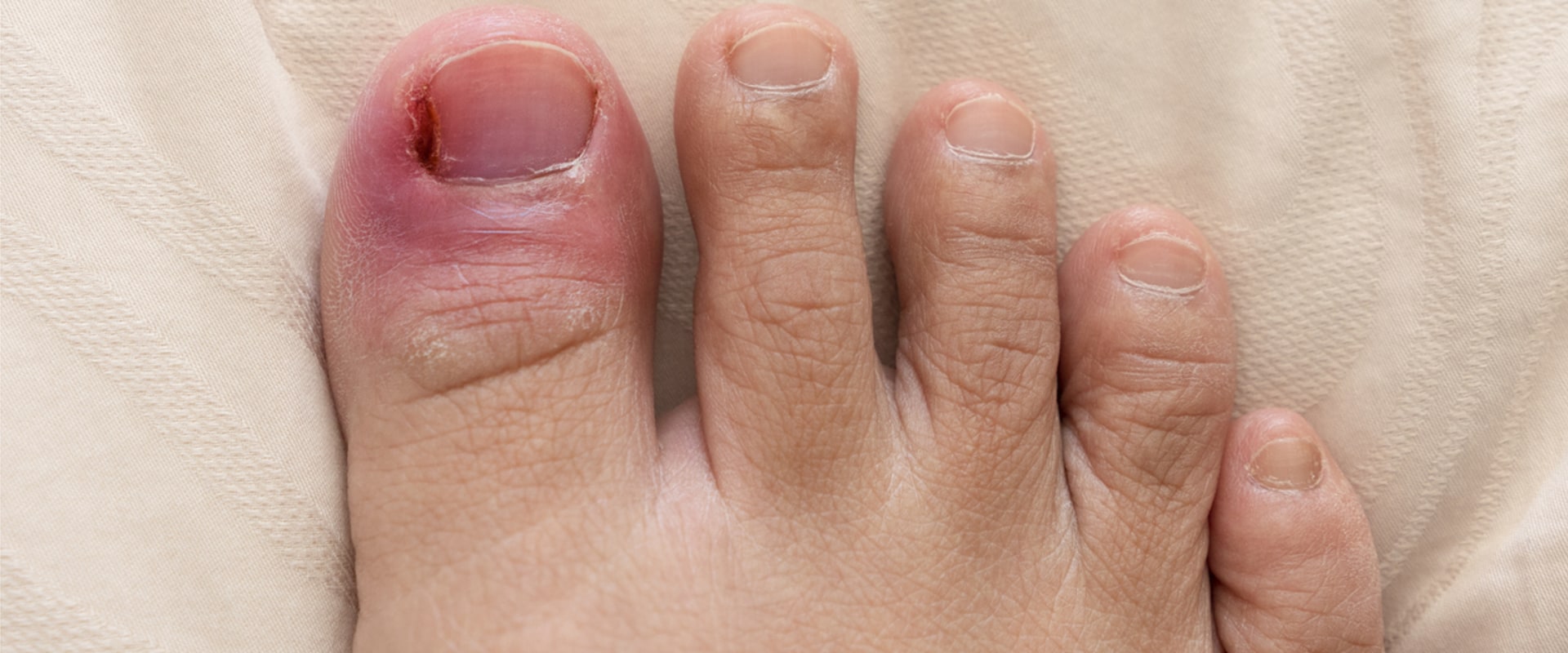 Ingrown Toenail Pictures & Symptoms: What Does an Ingrown Toenail Look ...